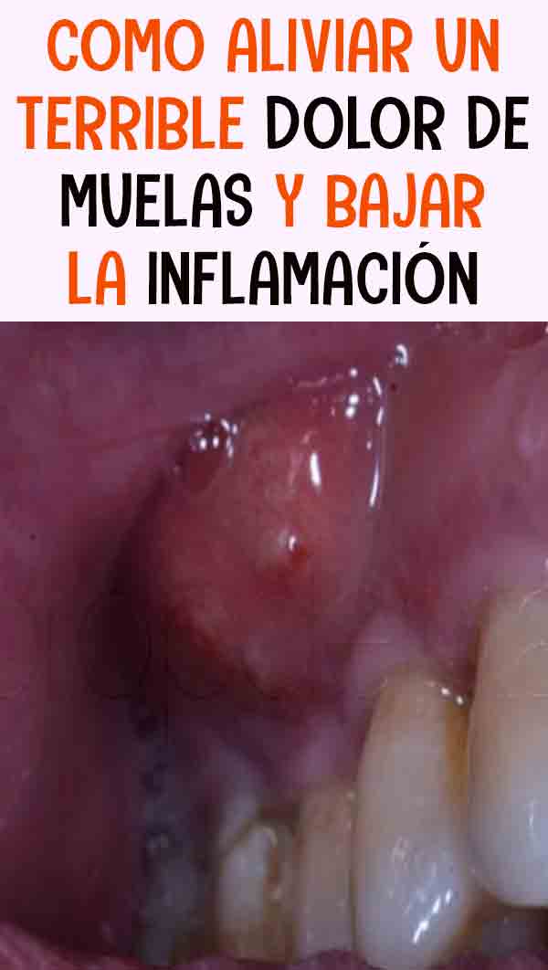 Como Aliviar Un Terrible Dolor De Muelas
